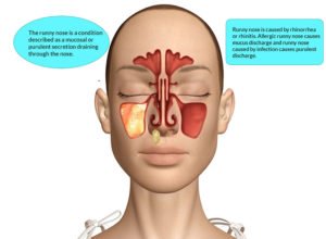 How To Stop Runny Nose – Love For Healthy Food